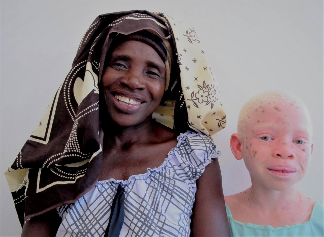 People With Albinism Benefit From Free Medical Consultations • 360 Angola